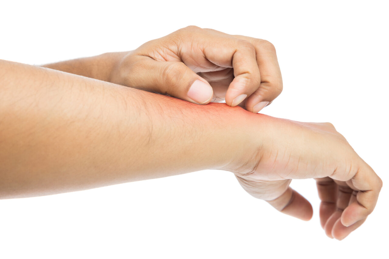 Understanding Excoriation Disorder: Symptoms, Causes, and Treatment ...